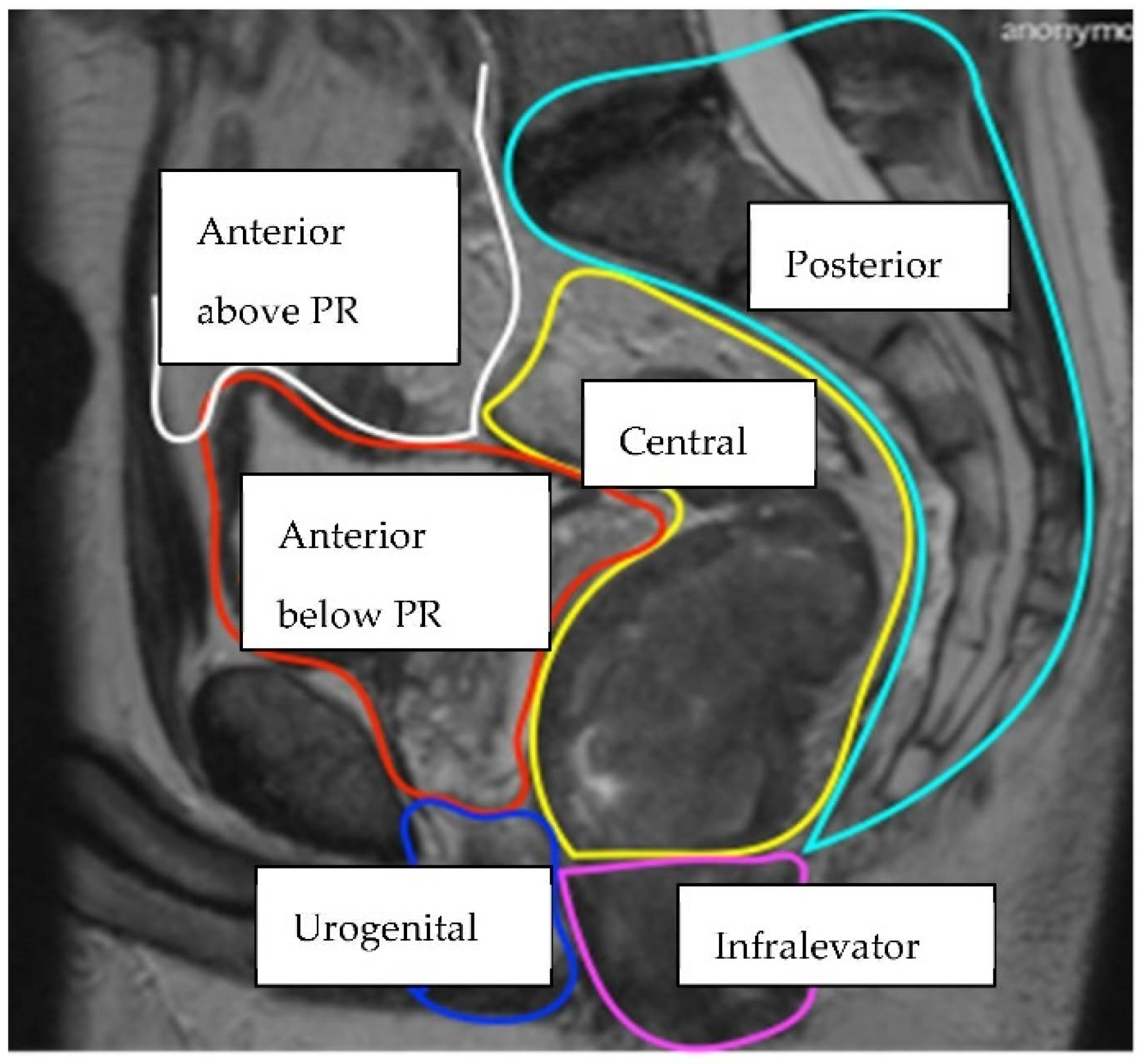 Jcm Free Full Text Locally Recurrent Rectal Cancer According To A