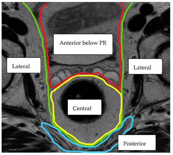 JCM | Free Full-Text | Locally Recurrent Rectal Cancer According to a ...