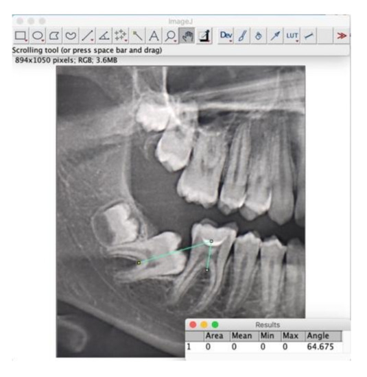 Mandibular Molar Uprighting Using Skeletal Anchorage: A Novel Approach