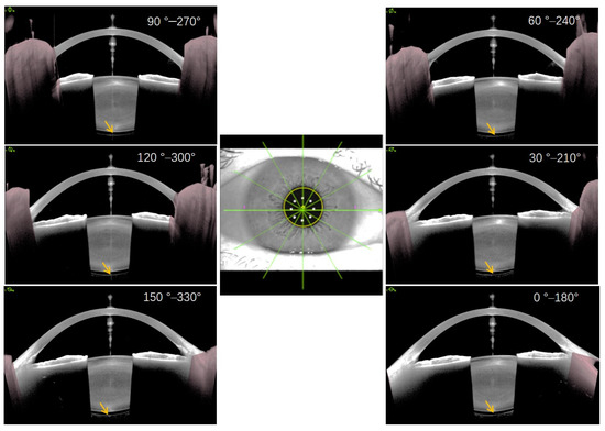 Incidence and Risk Factors for Berger’s Space Development after ...