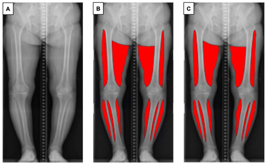 Deep Learning-Based Muscle Segmentation and Quantification of Full-Leg Plain Radiograph for ...