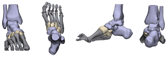 JCM | Free Full-Text | Evaluation and Management of Cavus Foot in ...