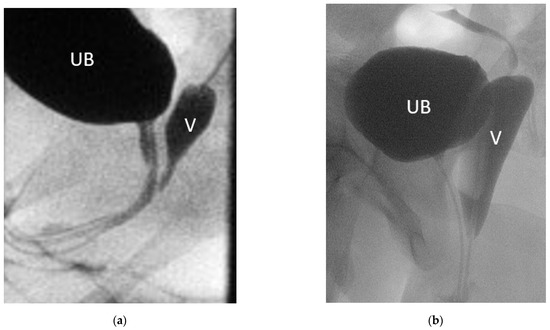 Techniques of Primary Vaginoplasty in Young Adults with Differences of ...