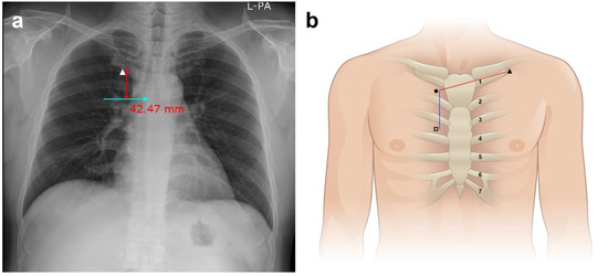 Accuracy of Catheter Positioning during Left Subclavian Venous Access ...