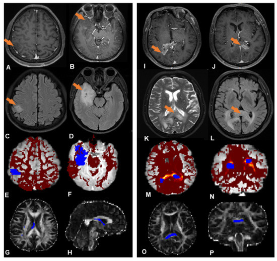 Two Patterns of White Matter Connection in Multiple Gliomas: Evidence ...