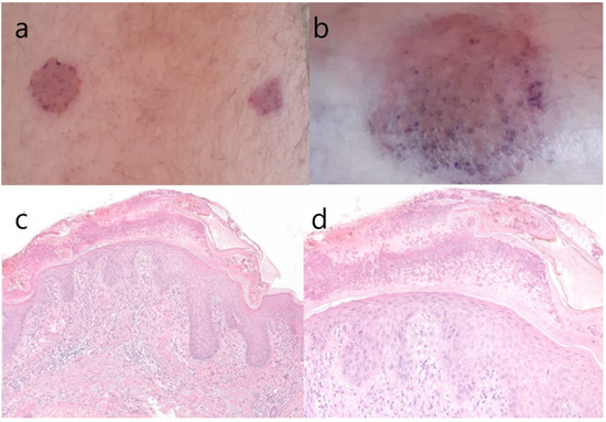 JCM | Free Full-Text | Cutaneous Adverse Reactions Associated with ...