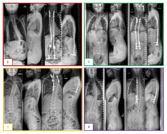 The Spring Distraction System for Growth-Friendly Surgical Treatment of ...