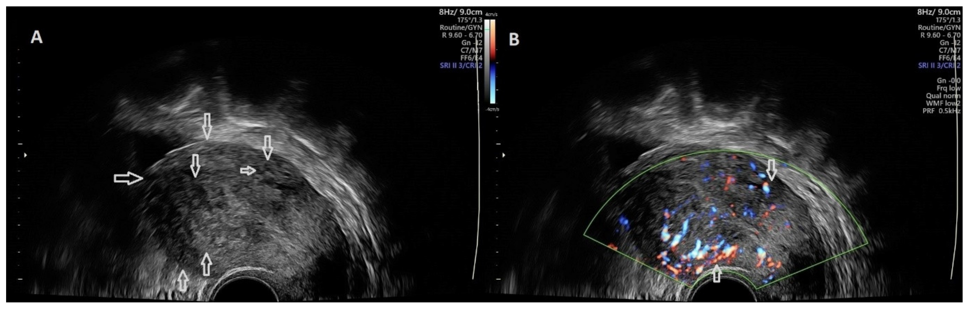 Jcm Free Full Text Transvaginal Ultrasound Combined With Strain