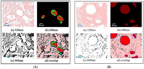 Segmentation and Recognition of the Pathological Features of Squamous ...