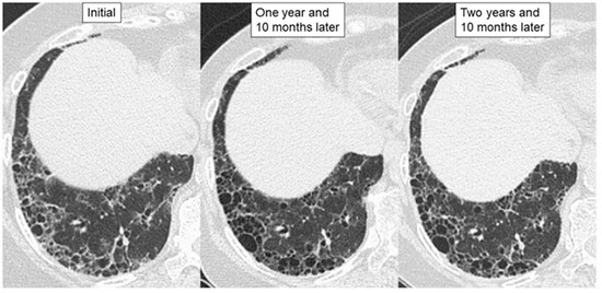 Anti-Inflammatory and/or Anti-Fibrotic Treatment of MPO-ANCA-Positive ...