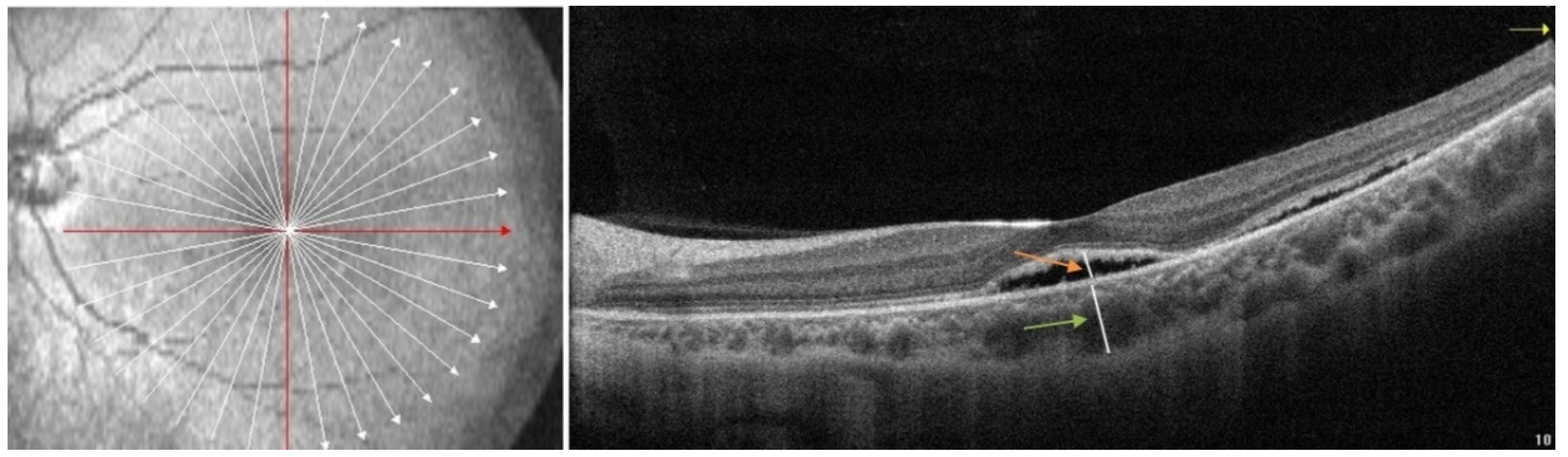 Effect of High Myopia on Delayed Absorption of Subretinal Fluid after ...