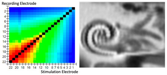 Assessing the Placement of the Cochlear Slim Perimodiolar Electrode ...