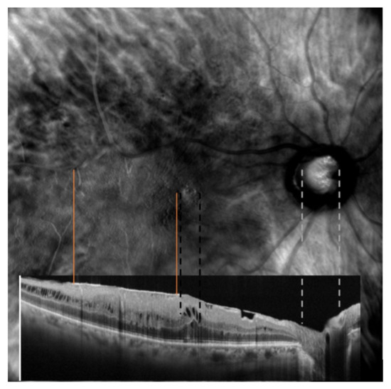 Retromode Imaging Modality of Epiretinal Membranes