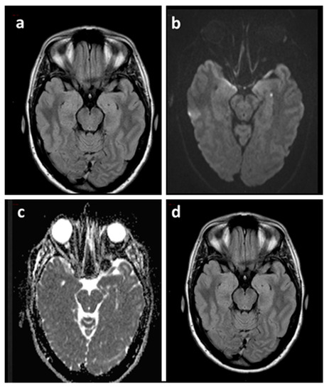Forgetting the Unforgettable: Transient Global Amnesia Part II: A ...