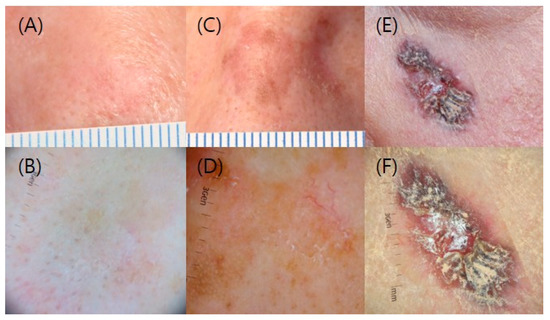 Actinic Keratosis Histology