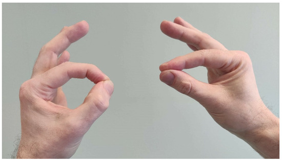 Proximal Median Nerve Compression in the Differential Diagnosis of ...