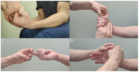 Proximal Median Nerve Compression in the Differential Diagnosis of ...