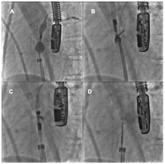 Advances in Percutaneous Patent Foramen Ovale Closure: From the ...