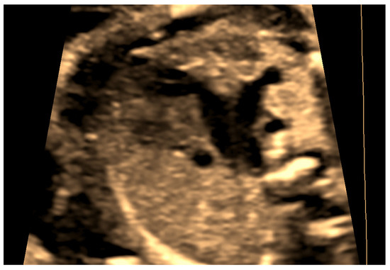 Persistent Left Superior Vena Cava Significance in Prenatal Diagnosis ...