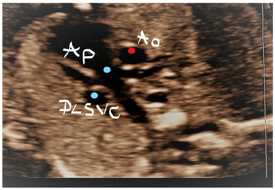 Persistent Left Superior Vena Cava Significance in Prenatal Diagnosis ...