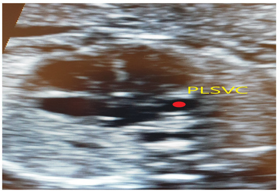 Persistent Left Superior Vena Cava Significance in Prenatal Diagnosis ...