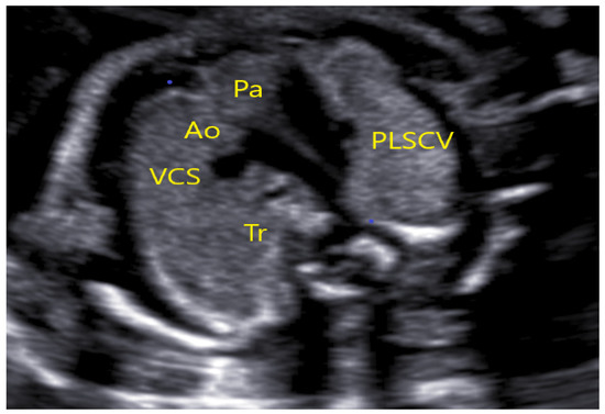 Persistent Left Superior Vena Cava Significance in Prenatal Diagnosis ...