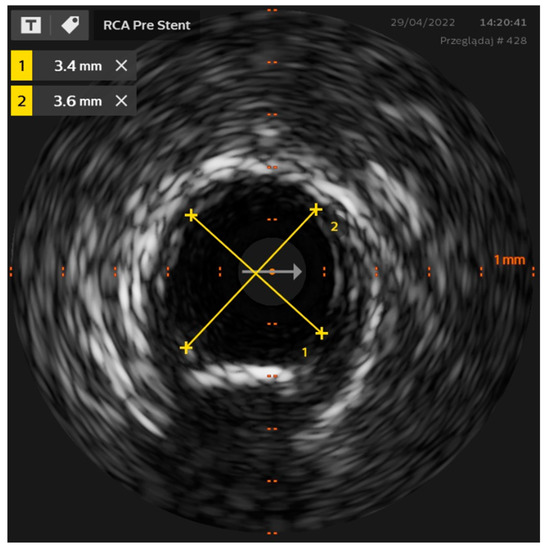 Comparative Appraisal of Intravascular Ultrasound and Optical Coherence ...