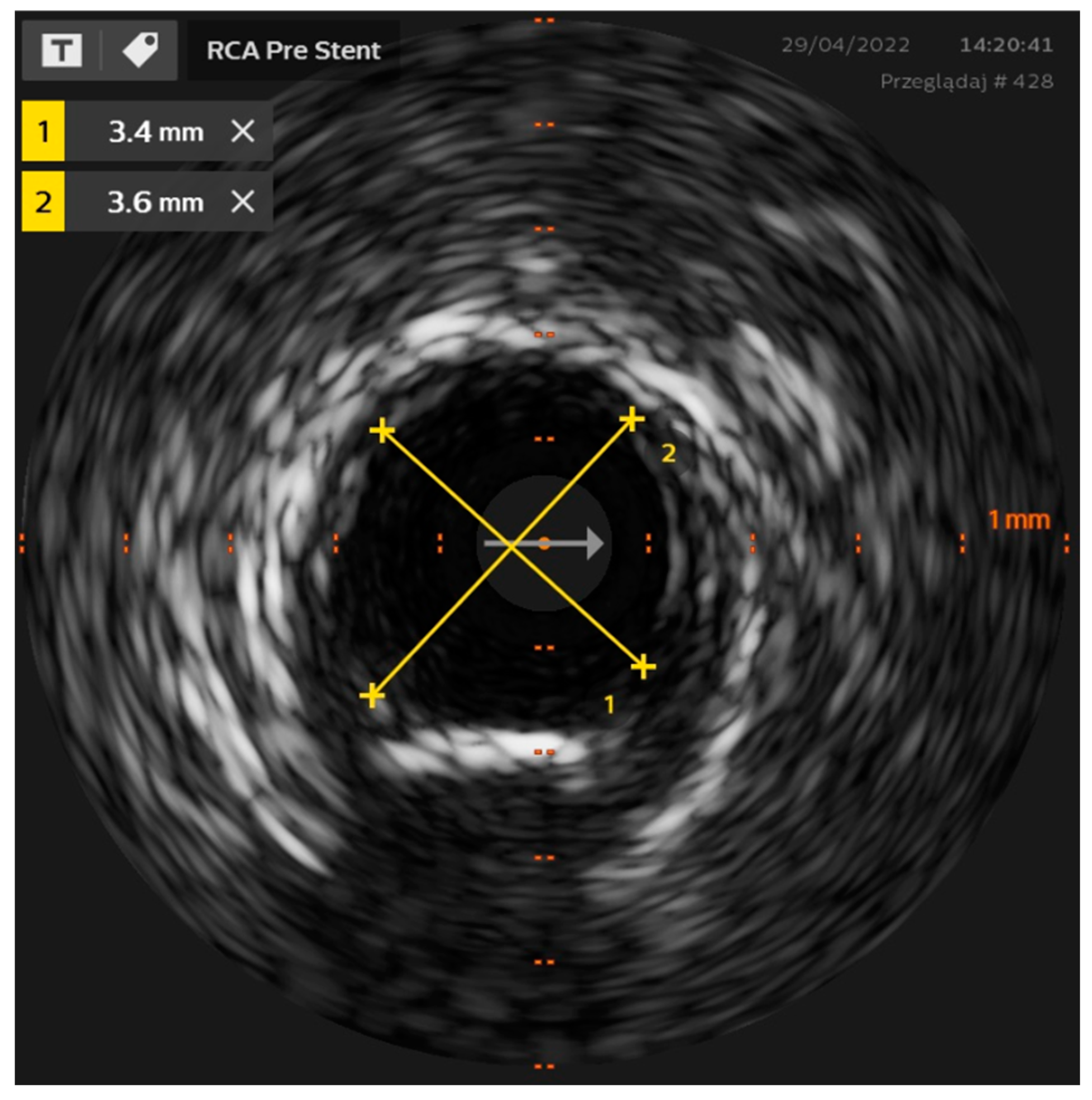 Comparative Appraisal of Intravascular Ultrasound and Optical Coherence Tomography in Invasive ...