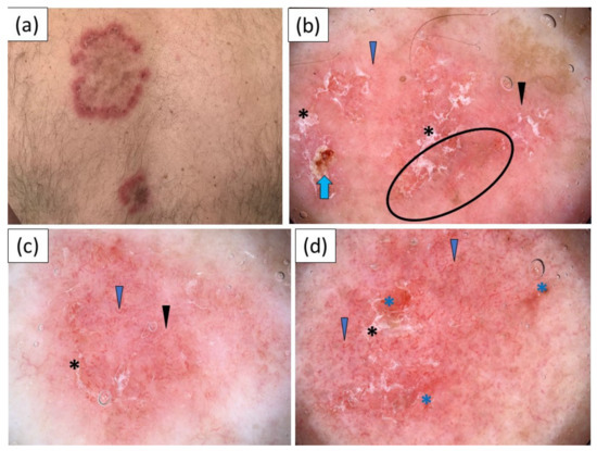 Jcm Free Full Text Dermoscopic Features Of Acute Subacute Chronic