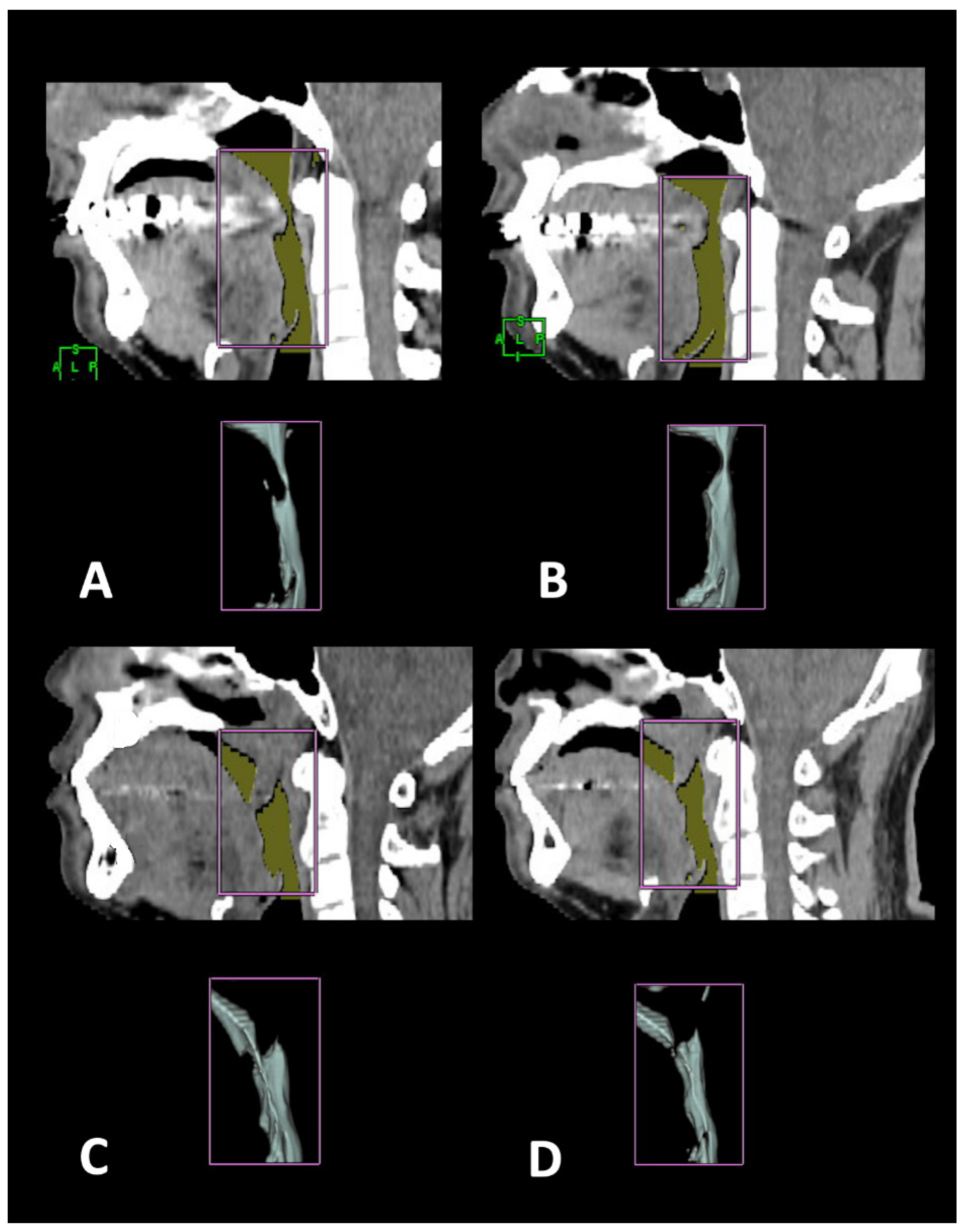Volumetric Changes after Coblation Ablation Tongue (CAT) in Obstructive ...