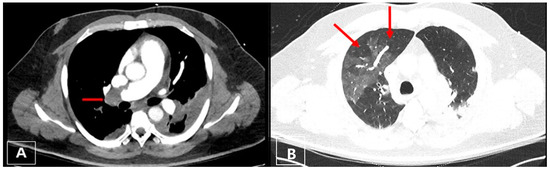 Acute on Chronic Thromboembolic Pulmonary Hypertension: Case Series and ...