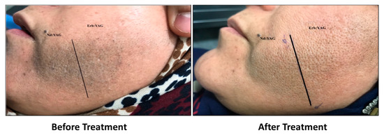 Evaluating the Roles of Different Types of Laser Therapy in Becker’s ...