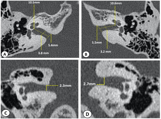 The Narrowed Internal Auditory Canal: A Distinct Etiology of Pediatric ...