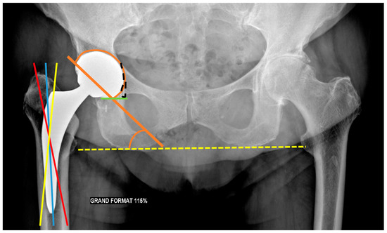 Imaging in Hip Arthroplasty Management Part 2: Postoperative Diagnostic ...