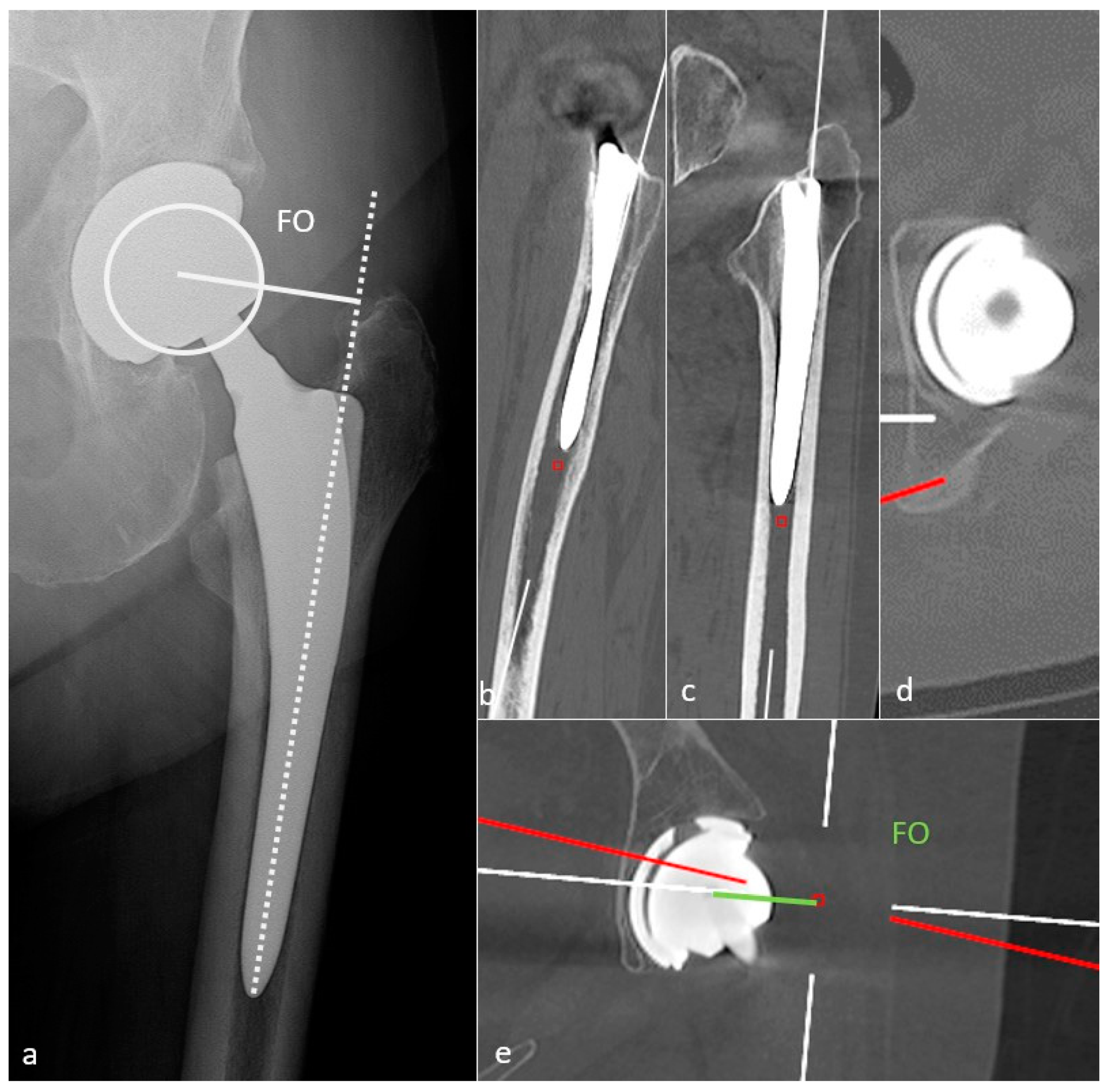 Imaging in Hip Arthroplasty Management Part 2: Postoperative Diagnostic ...