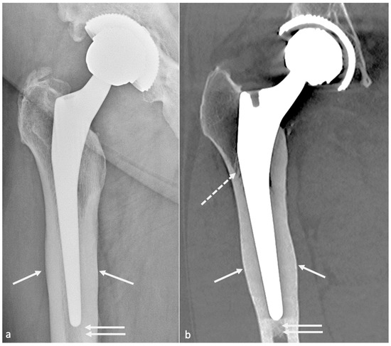 Imaging in Hip Arthroplasty Management Part 2: Postoperative Diagnostic ...