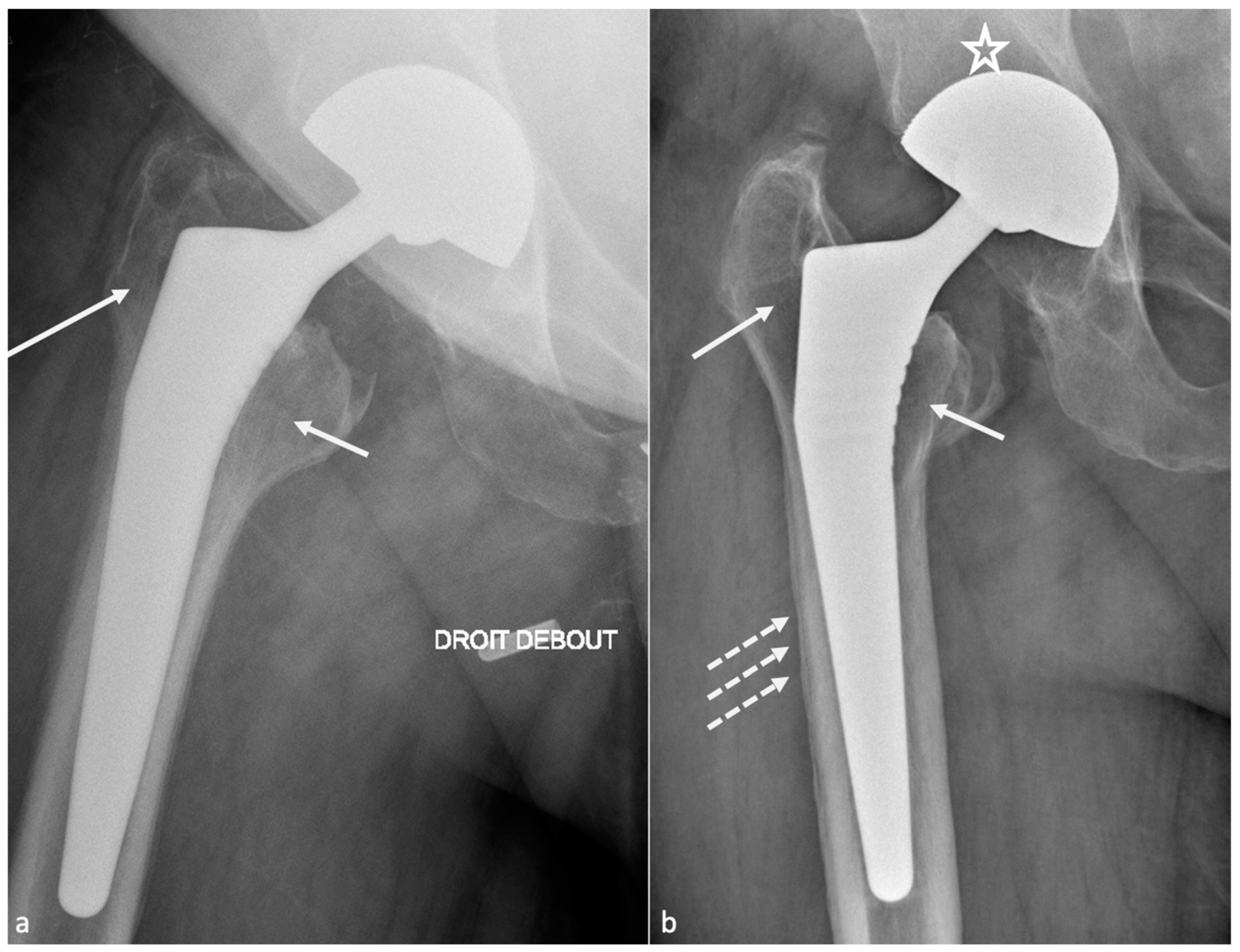 Imaging in Hip Arthroplasty Management Part 2: Postoperative Diagnostic ...
