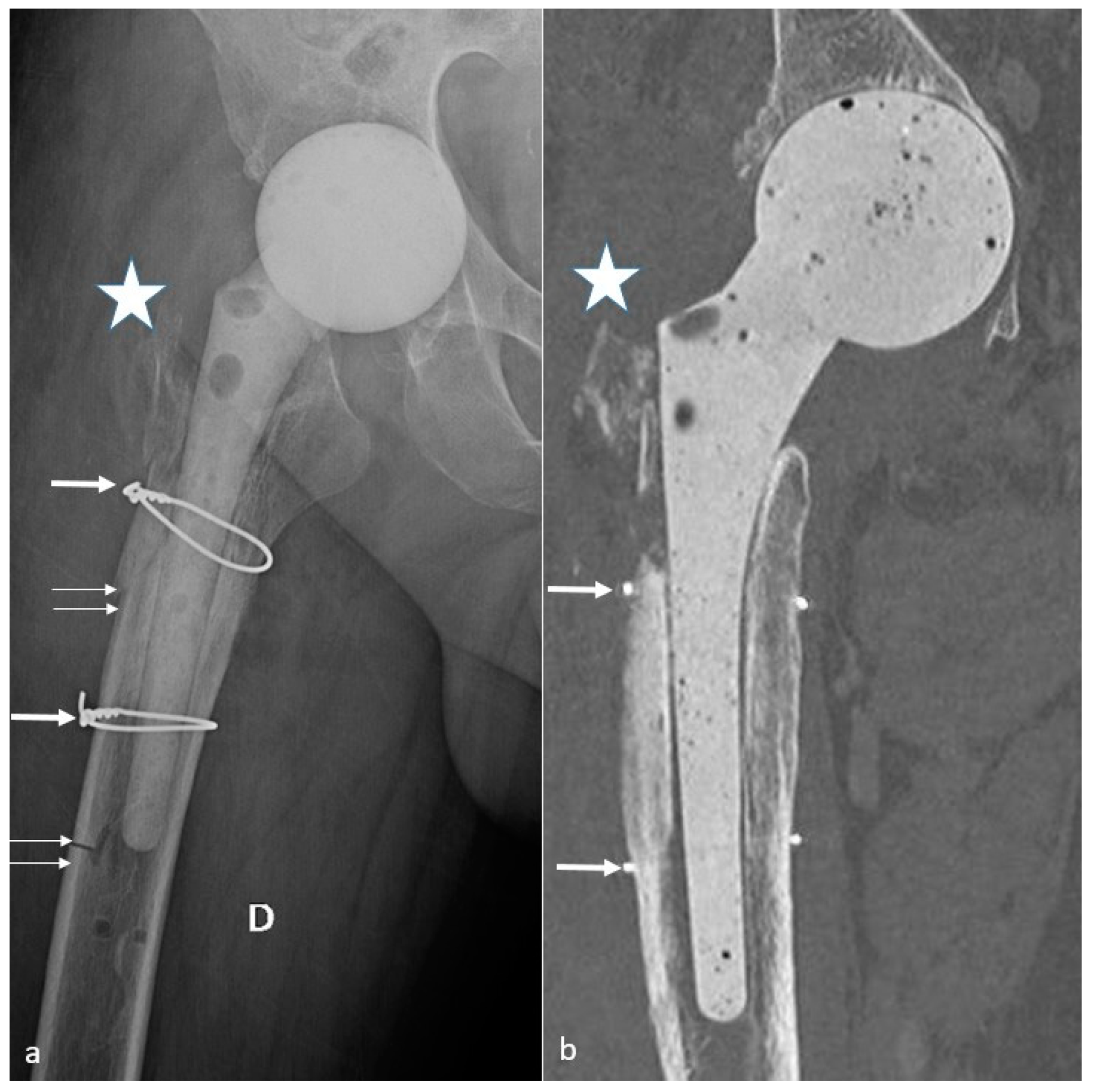 Imaging in Hip Arthroplasty Management Part 2: Postoperative Diagnostic ...