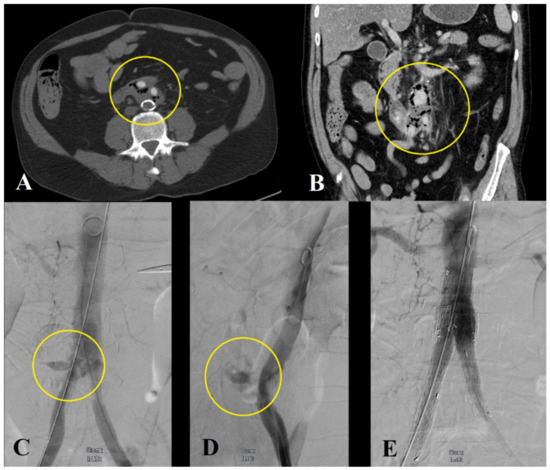 Treatment of Secondary Aortoenteric Fistulas Following AORTIC Aneurysm ...