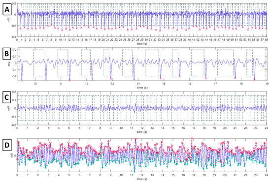 Fibrillatory Wave Amplitude Evolution during Persistent Atrial ...