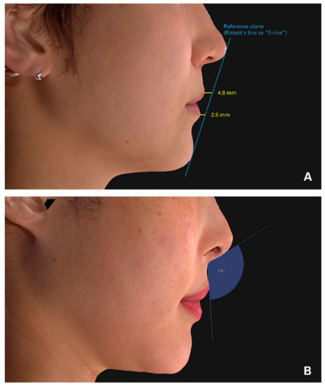 Lip Lifting Efficacy of Hyaluronic Acid Filler Injections: A ...