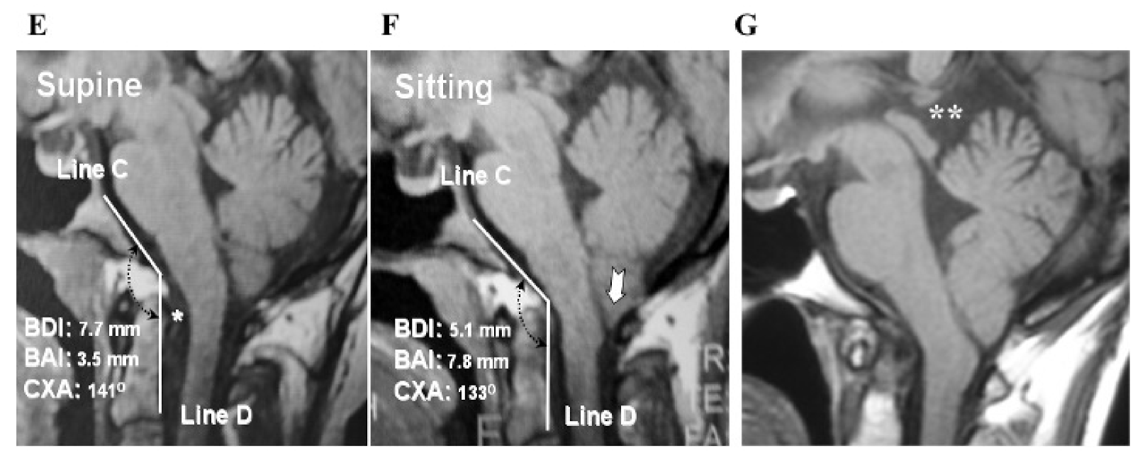 Jcm Free Full Text Surgical Management Of Chiari Malformation Type