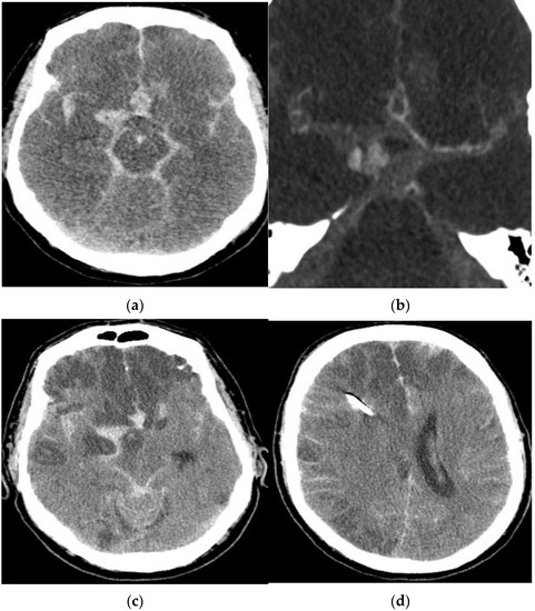 Vasospasm-Related Death after Aneurysmal Subarachnoid Hemorrhage: A Retrospective Case–Control Study