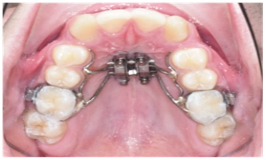 Skeletal, Dentoalveolar and Dental Changes after “Mini-Screw Assisted ...