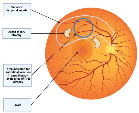 Subretinal Injection Techniques for Retinal Disease: A Review