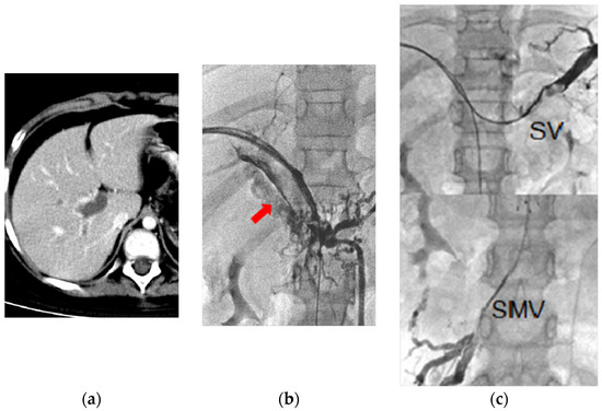 Primary Catheter-Directed Thrombolysis for Porto-Mesenteric Venous ...