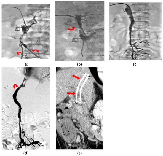 Primary Catheter-Directed Thrombolysis for Porto-Mesenteric Venous ...