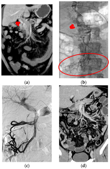 Primary Catheter-Directed Thrombolysis for Porto-Mesenteric Venous ...