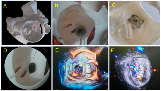 3D-Printing to Plan Complex Transcatheter Paravalvular Leaks Closure