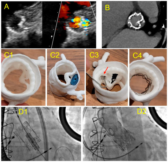 3D-Printing to Plan Complex Transcatheter Paravalvular Leaks Closure